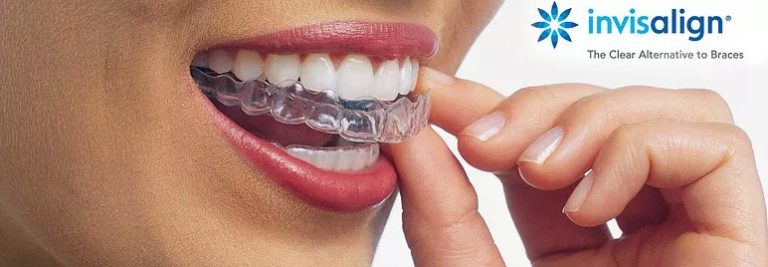Invisalign - Diley Ridge Dental